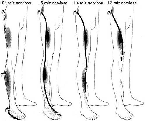 Ciática (Término Médico: Ciatalgia, Cruralgia) – Dr. Luis Alberto Lee